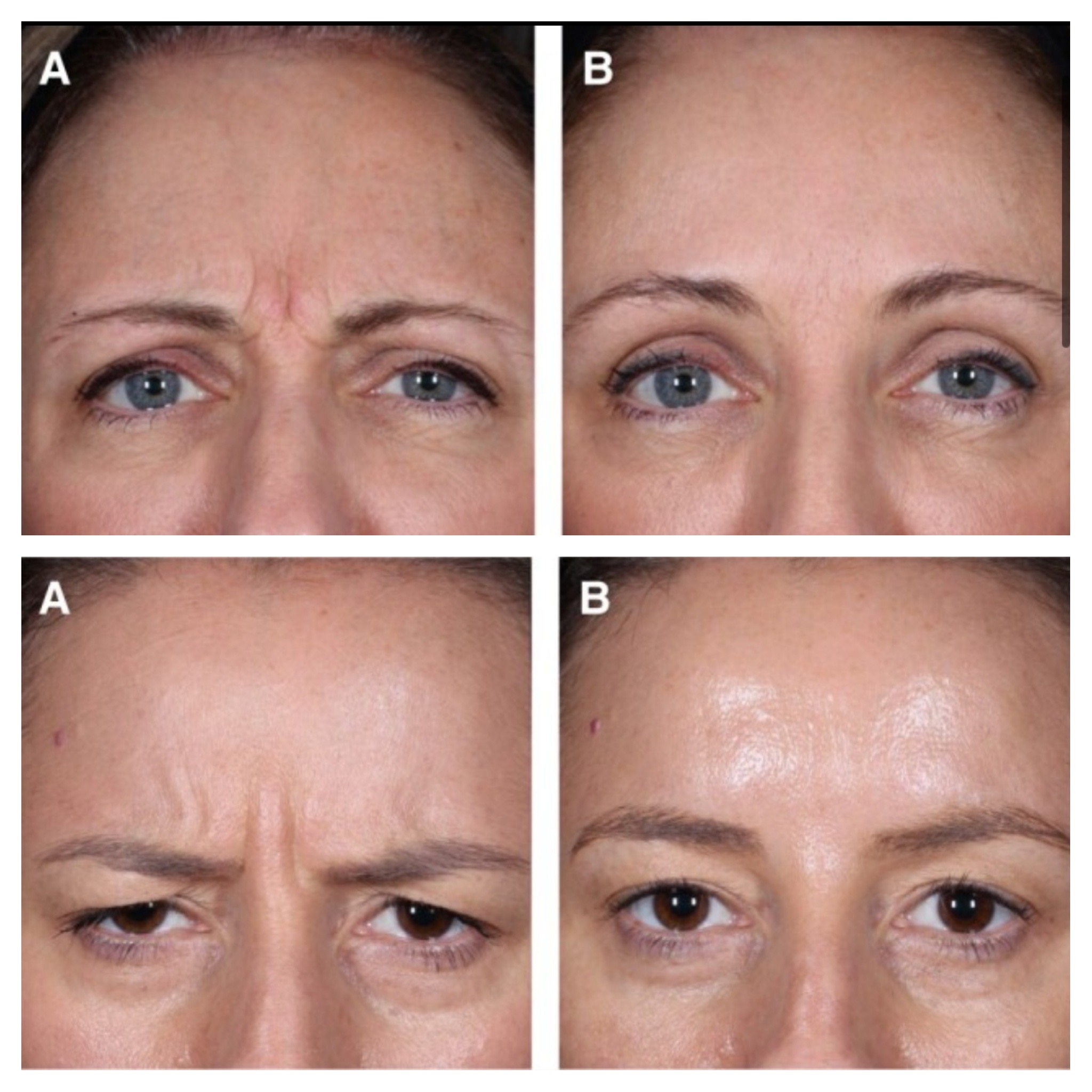 Letybo - The K-Beauty Botox is Here! by SkinMD Seattle Laser and Aesthetic Medical Clinic in ...